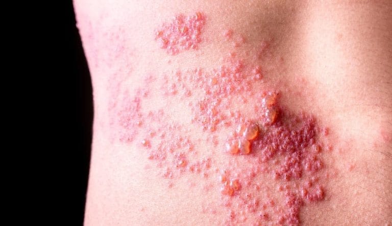 Gece Yanığı Nedir, Neden Olur, Zona Nasıl Geçer?